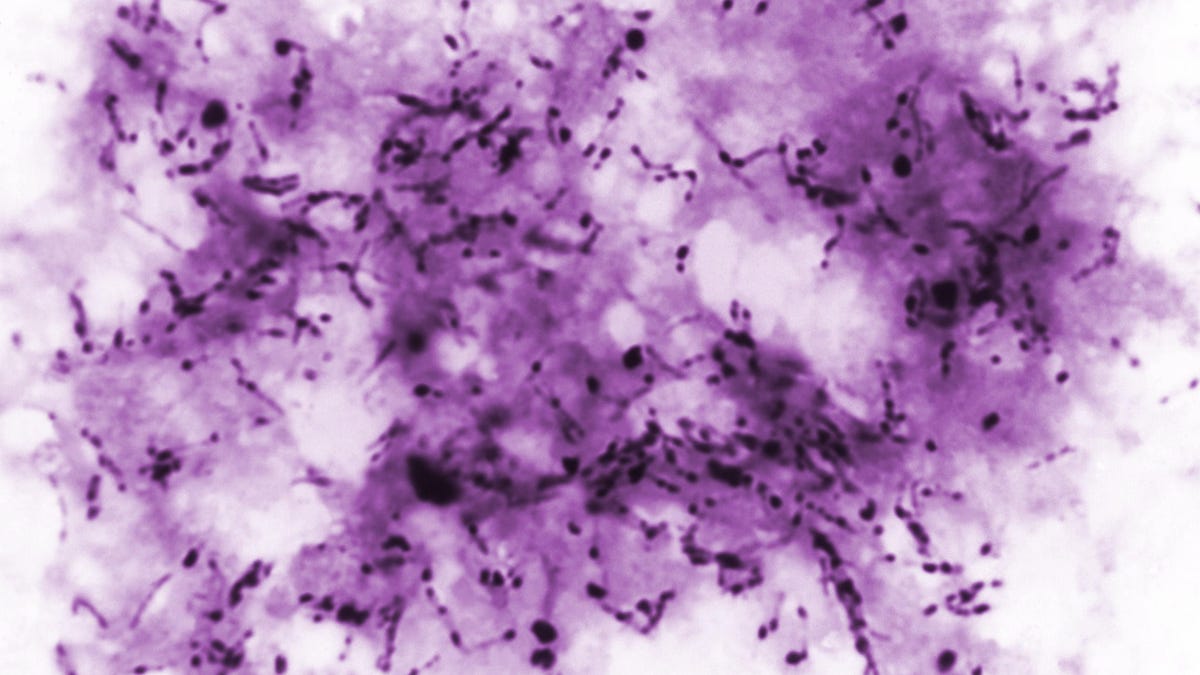 Bizarre Outbreak Of Tuberculosis Linked To Donated Bone Grafts Cdc And Fda Officials Say