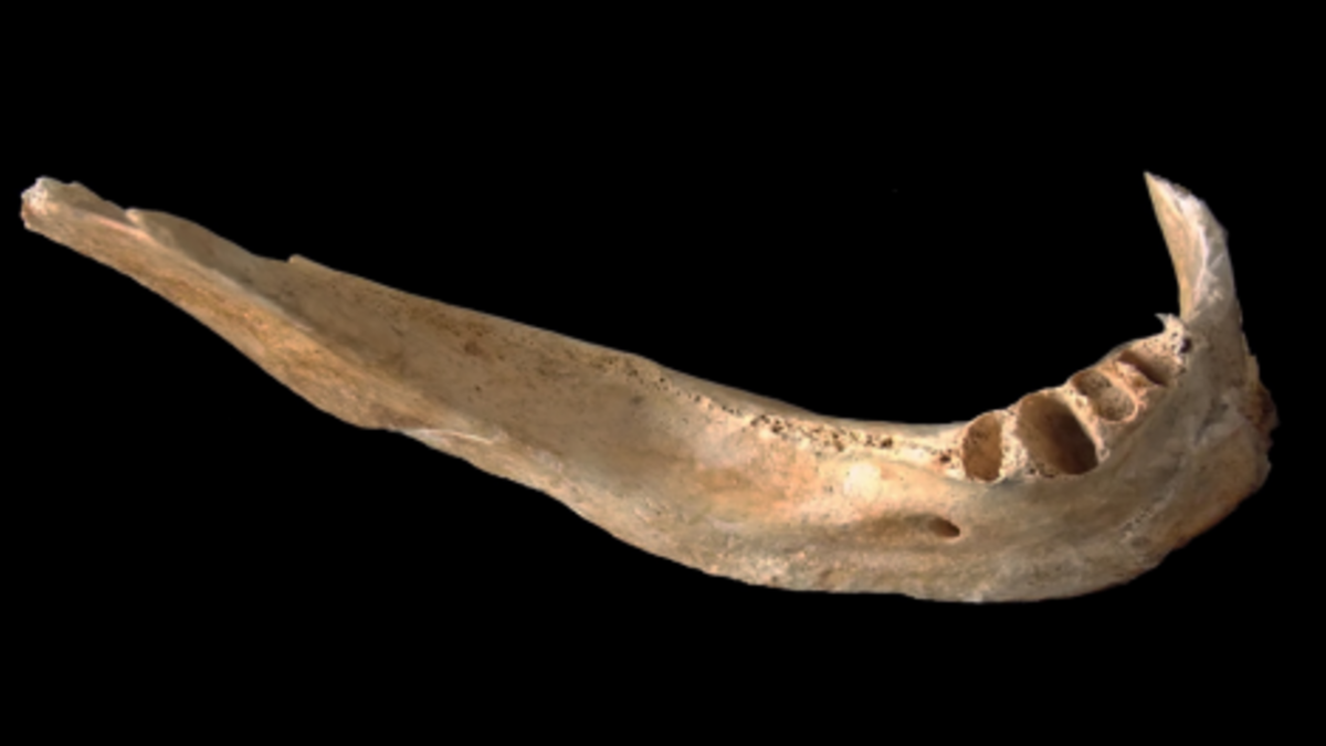 Human Bone Fragment Reveals Radiation Exposure From Hiroshima Bombing