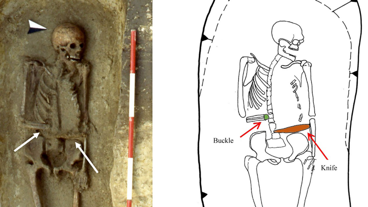 Medieval Italian Man Replaced His Amputated Hand With a Knife Medieval Italian Man Replaced His Amputated Hand With a Knife