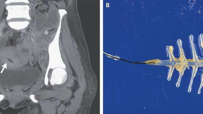 A Woman's IUD Left Inside for 20 Years Was Covered by Bacteria That ...
