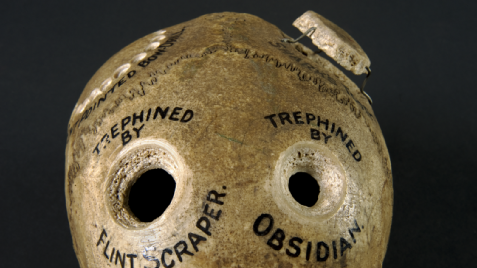 Four methods of trepanation demonstrated on a single human skull