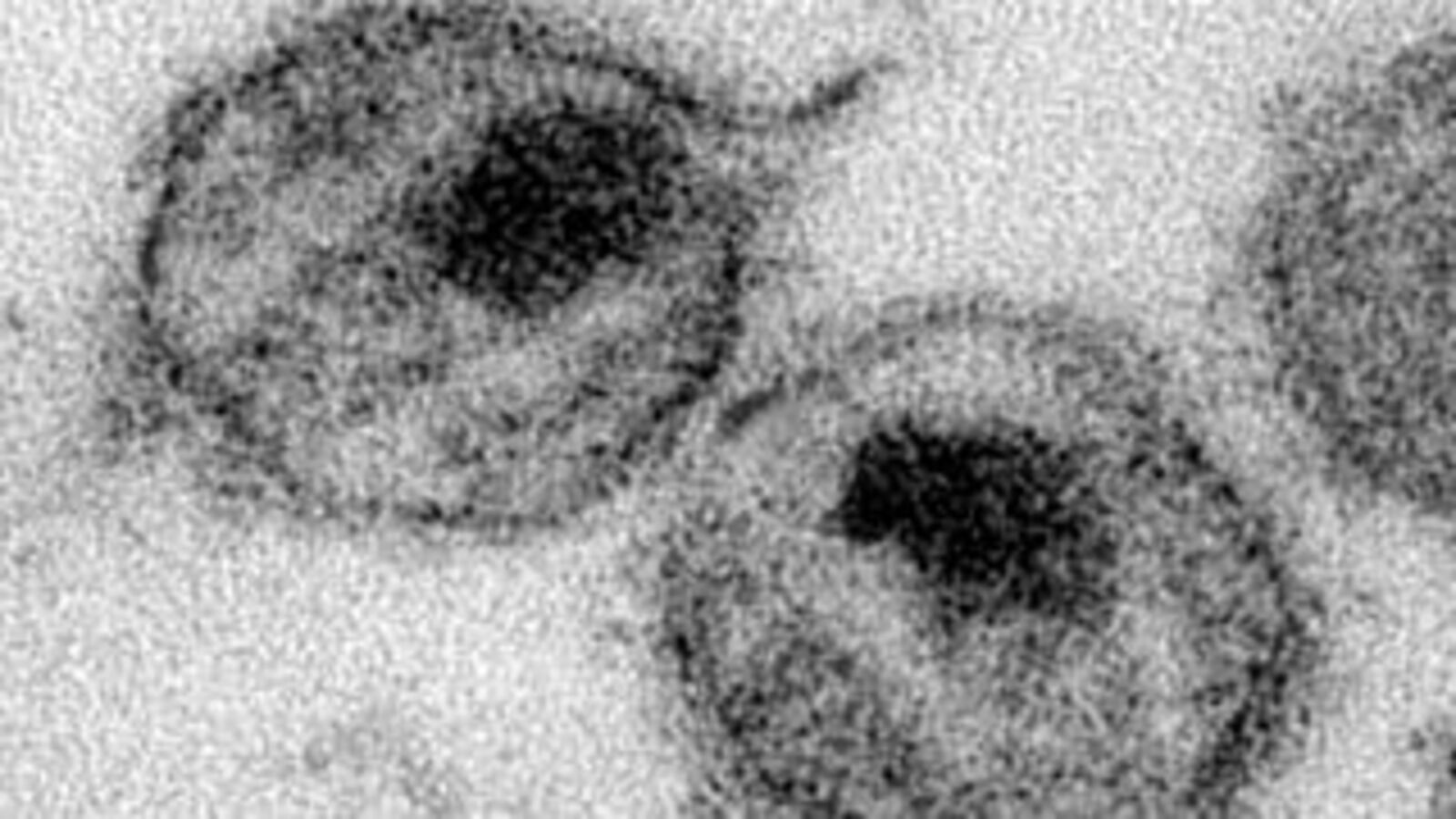 For the Second Time, Doctors Say They've Cleared an HIV Infection Using ...