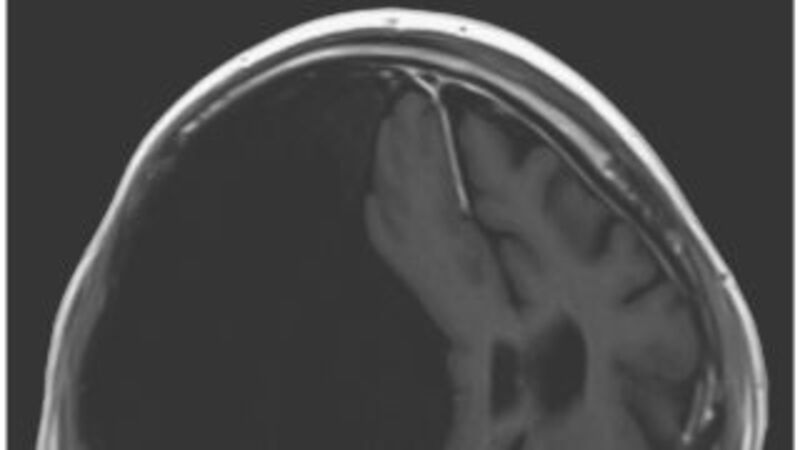Look at This Crazy Brain Cyst